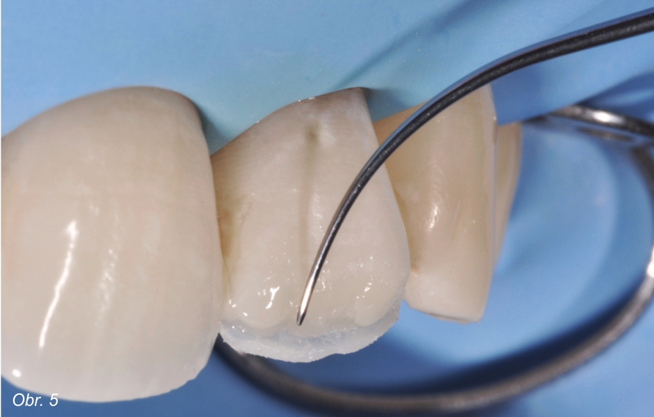 Jak lze být úspěšný při estetickém vrstvení za použití správných ...